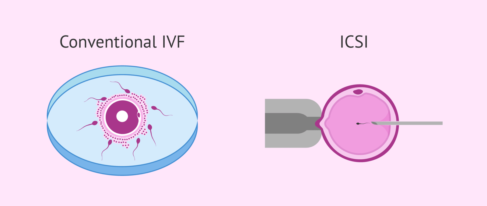 IVF (In-Vitro Fertilization) - Sparsh Meditunes Hospital